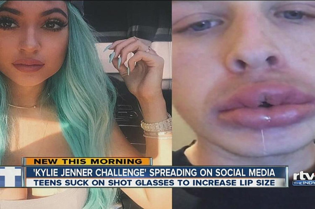 That Kylie Jenner lip challenge isn’t just stupid — it’s dangerous ...